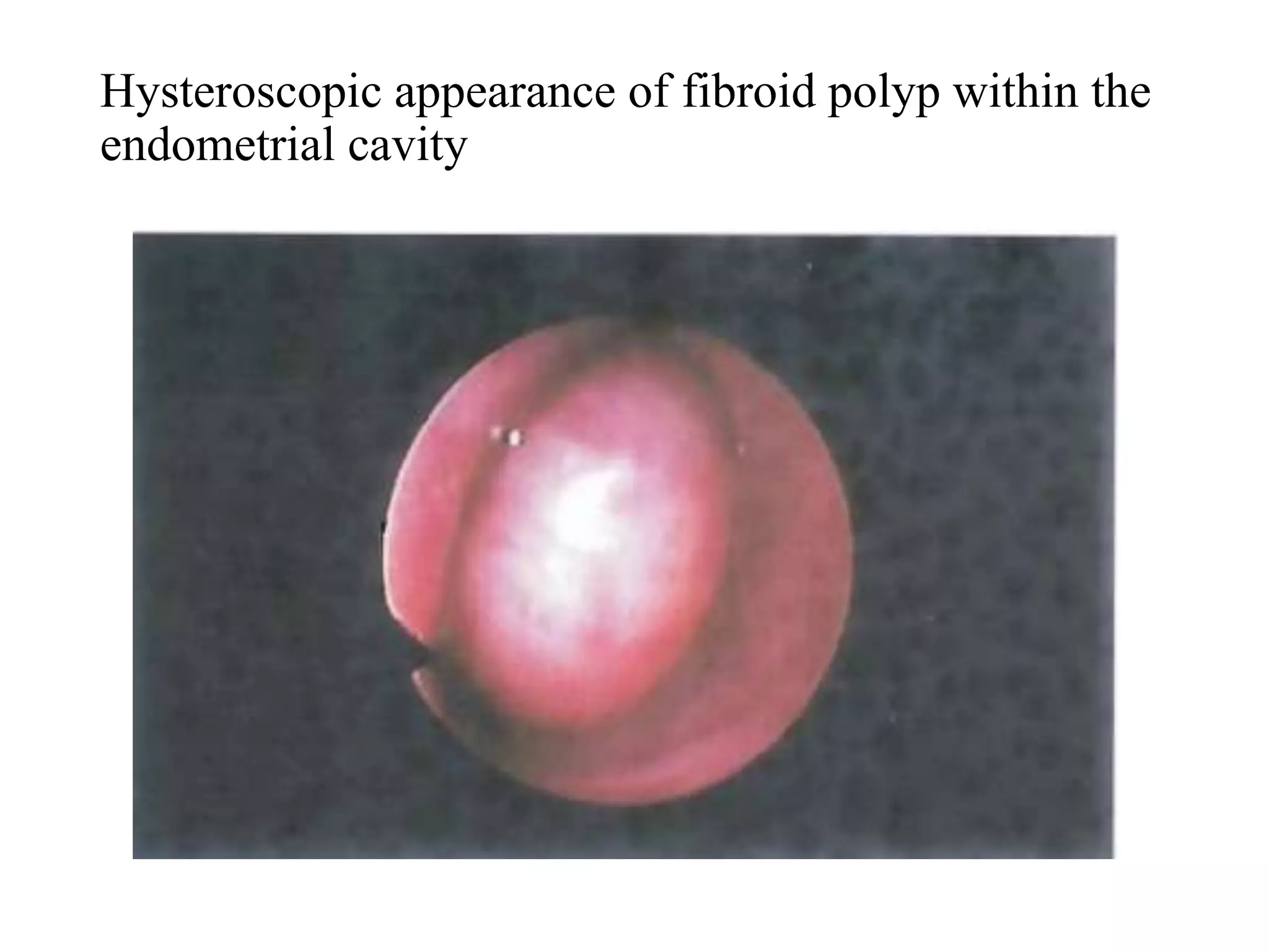Uterine fibroids, Benign tumor of the Uterus (Leimyoma) | PPTX