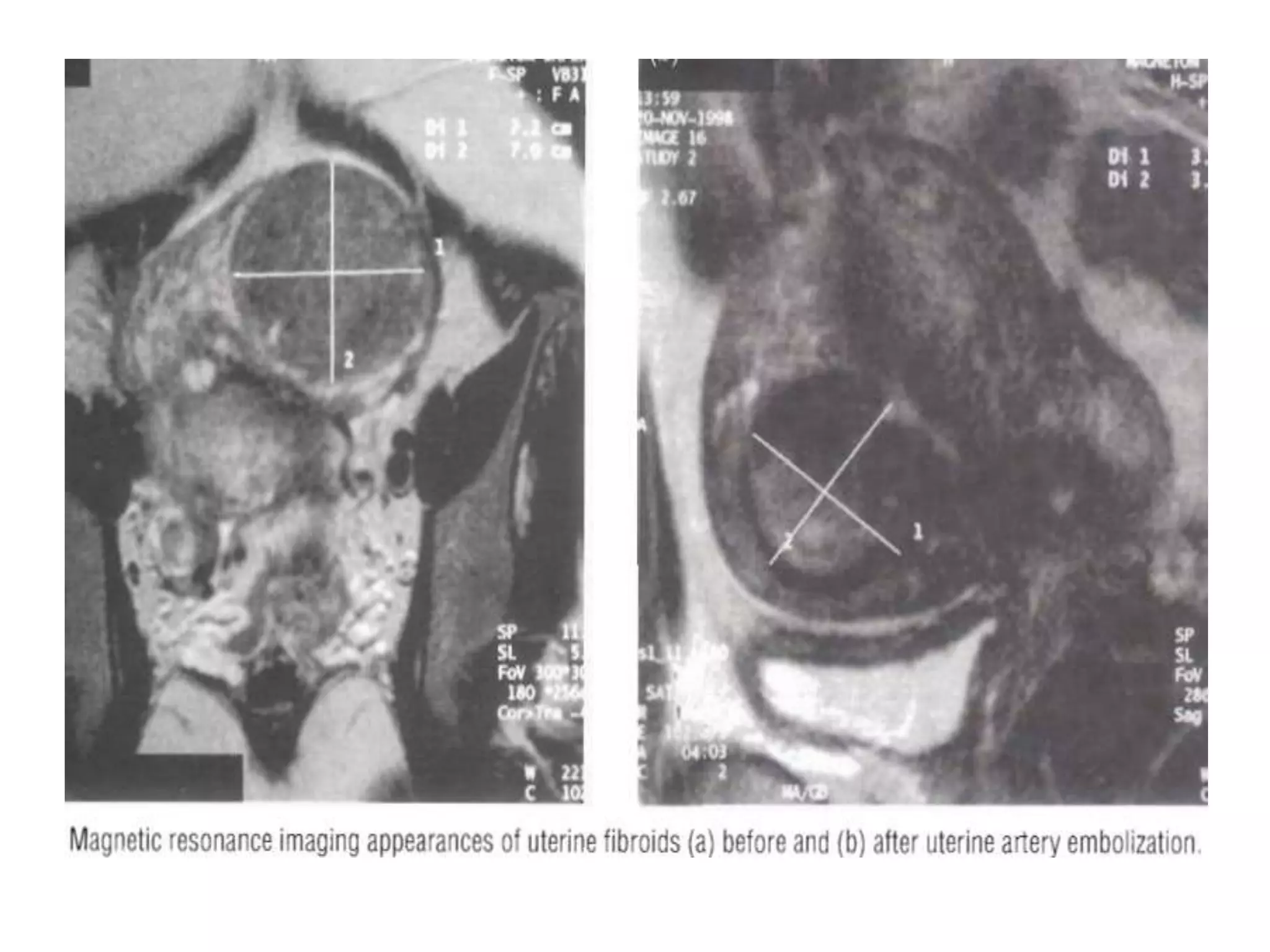 Uterine fibroids, Benign tumor of the Uterus (Leimyoma) | PPTX