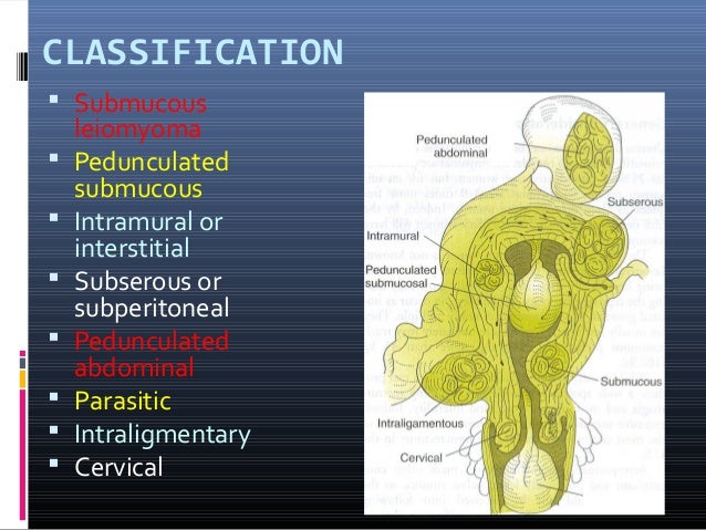 Intramural Fibroid Uterus