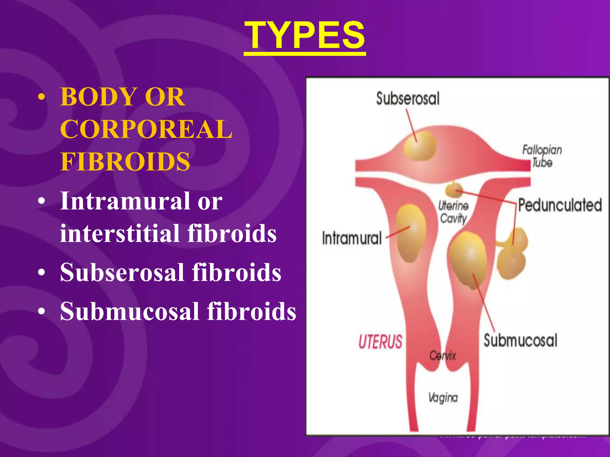 Uterine Fibroids Ppt