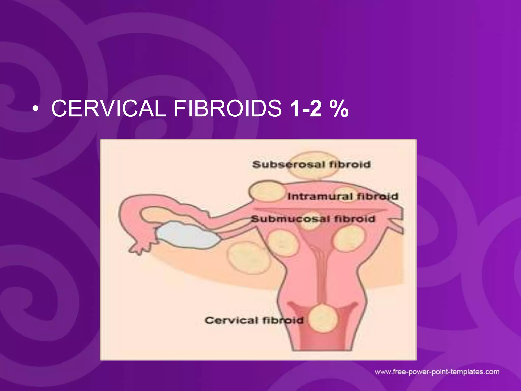 Uterine fibroids | PPTX