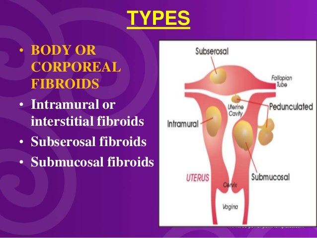 Uterine fibroids