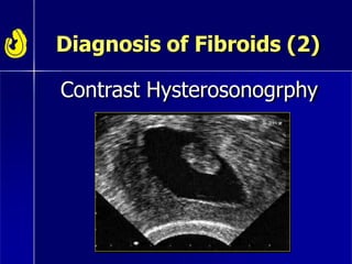 uterinefibroids-180412190811.pptx