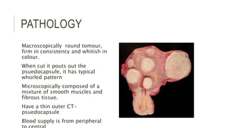 Uterine fibroids.pptx