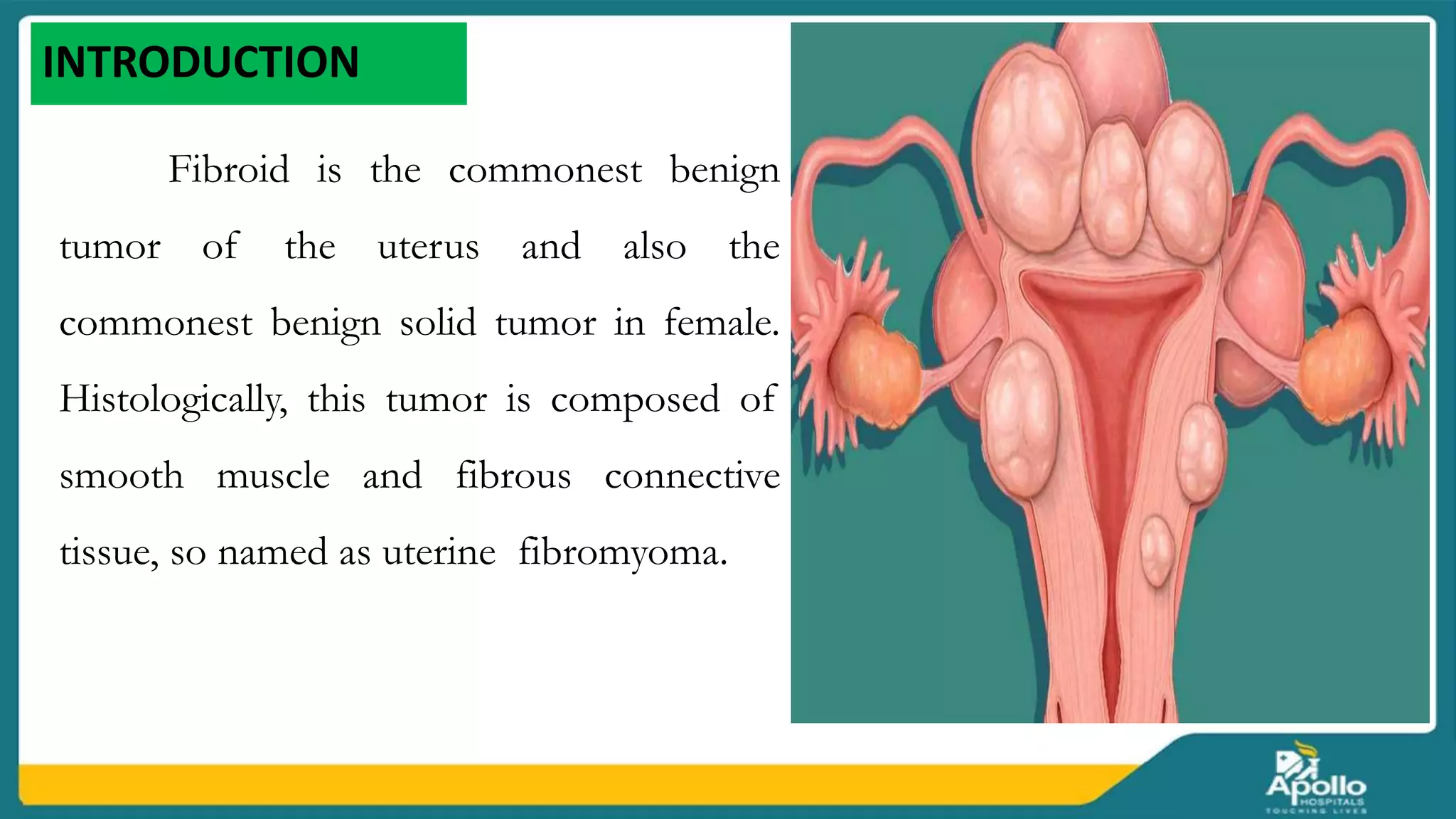 uterine fibroids.pptx