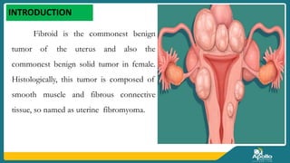 uterine fibroids.pptx
