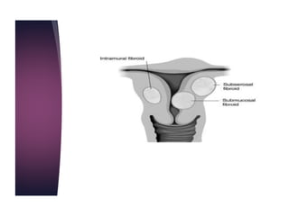 Uterine Fibroids.pptx