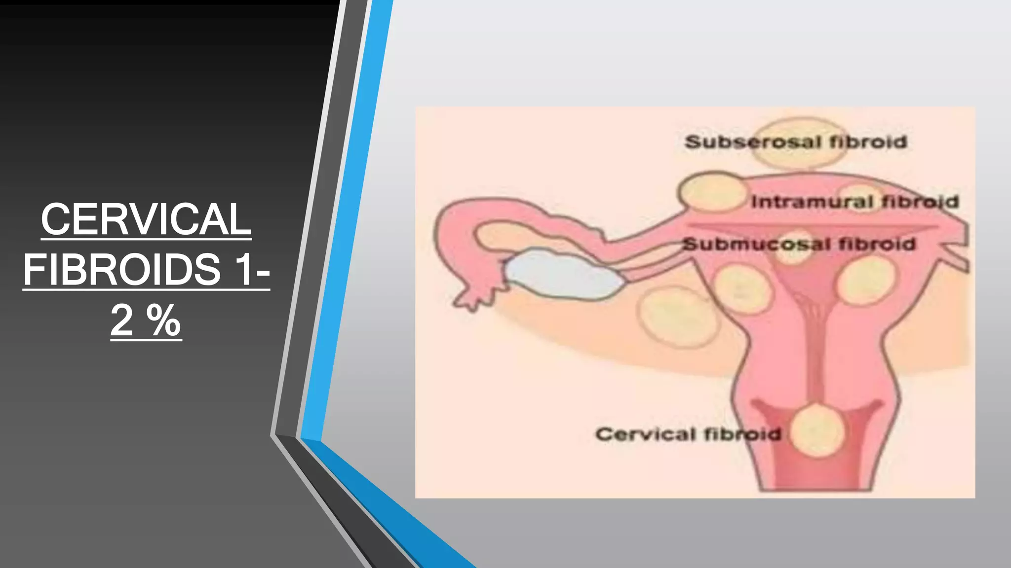 UTERINE FIBROIDS.pptx