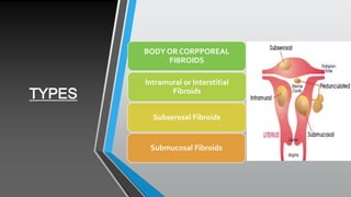 UTERINE FIBROIDS.pptx