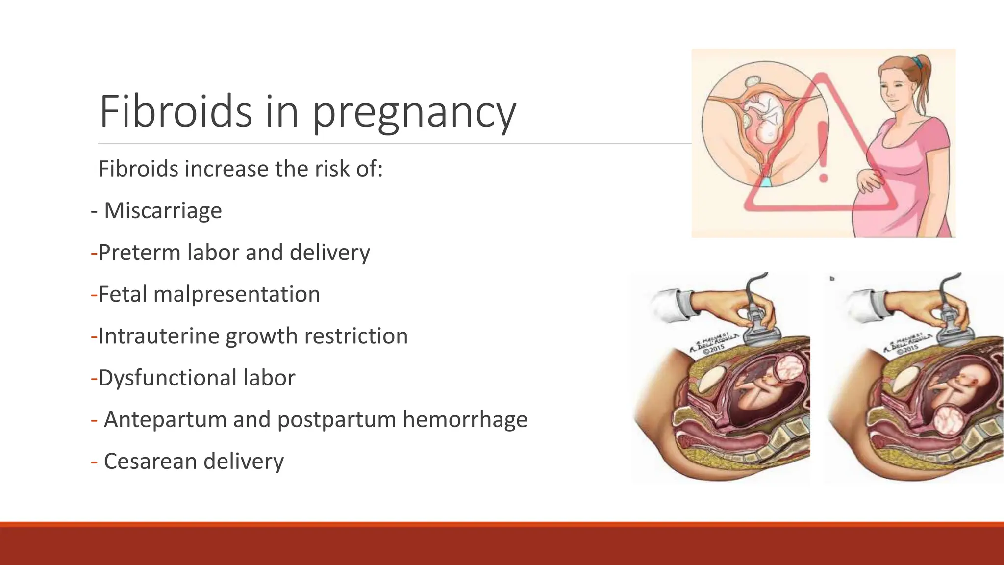 uterine fibroids. bleeding. myoma pptxjj | PPT