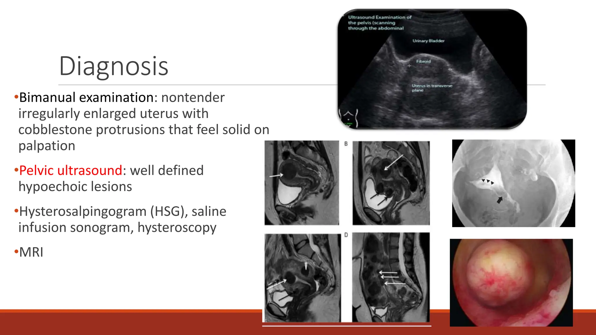 uterine fibroids. bleeding. myoma pptxjj | PPT