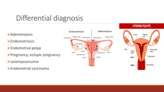 uterine fibroids. bleeding. myoma pptxjj | PPTX