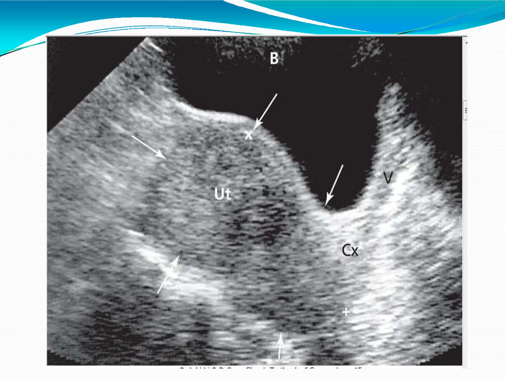 UTERINE FIBROIDS .pptxxxxxxxxxxxxxxxxxxx | PPT