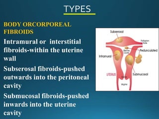 Uterinefibroids chandni | PPTX