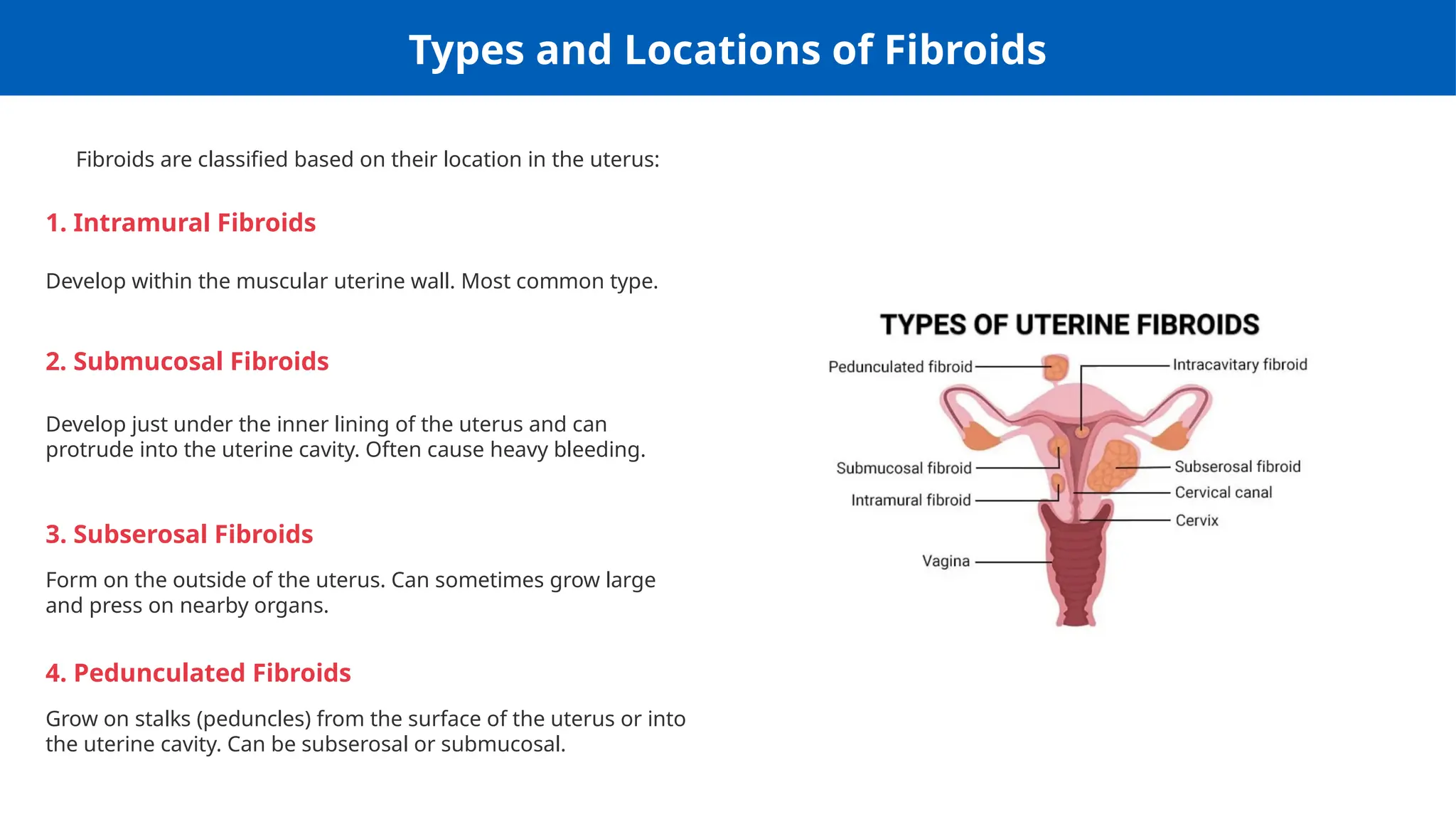Uterine_Fibroids_A_Comprehensive_Overview.pptx