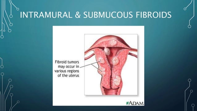 Uterine Fibroids Ppt