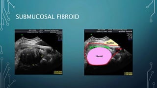 Uterine fibroids | PPTX