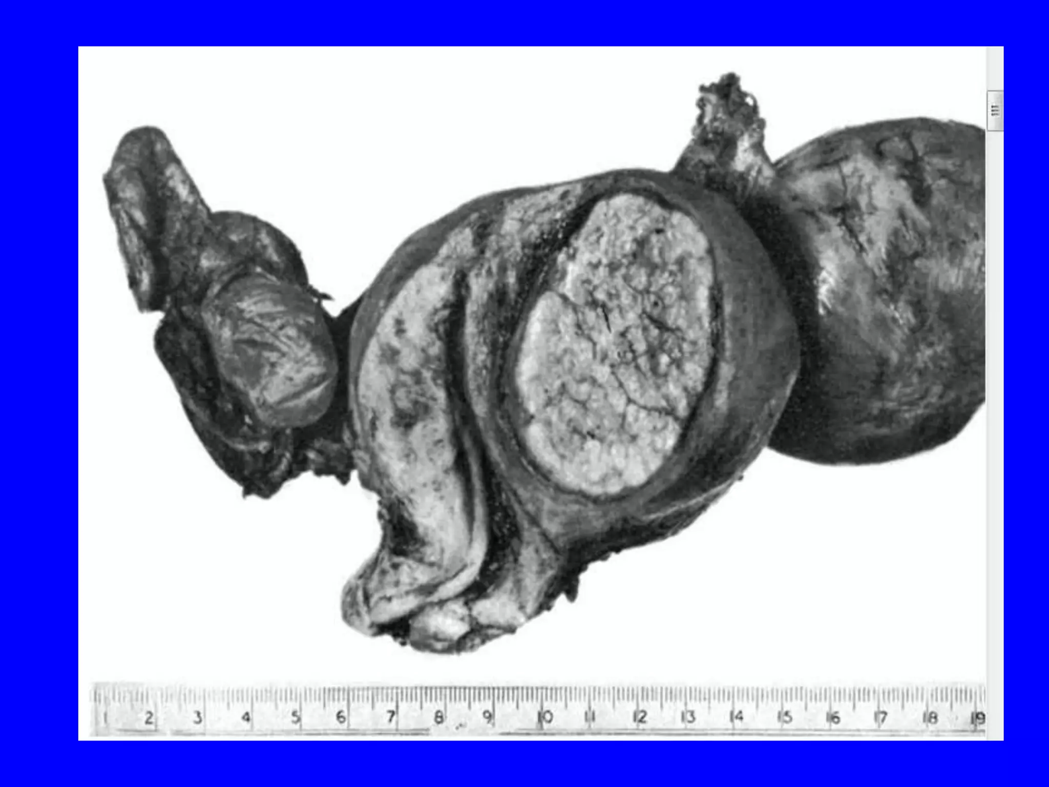 Uterine fibroids | PPT