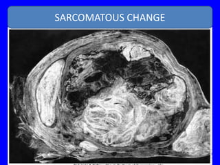 Uterine fibroids | PPTX