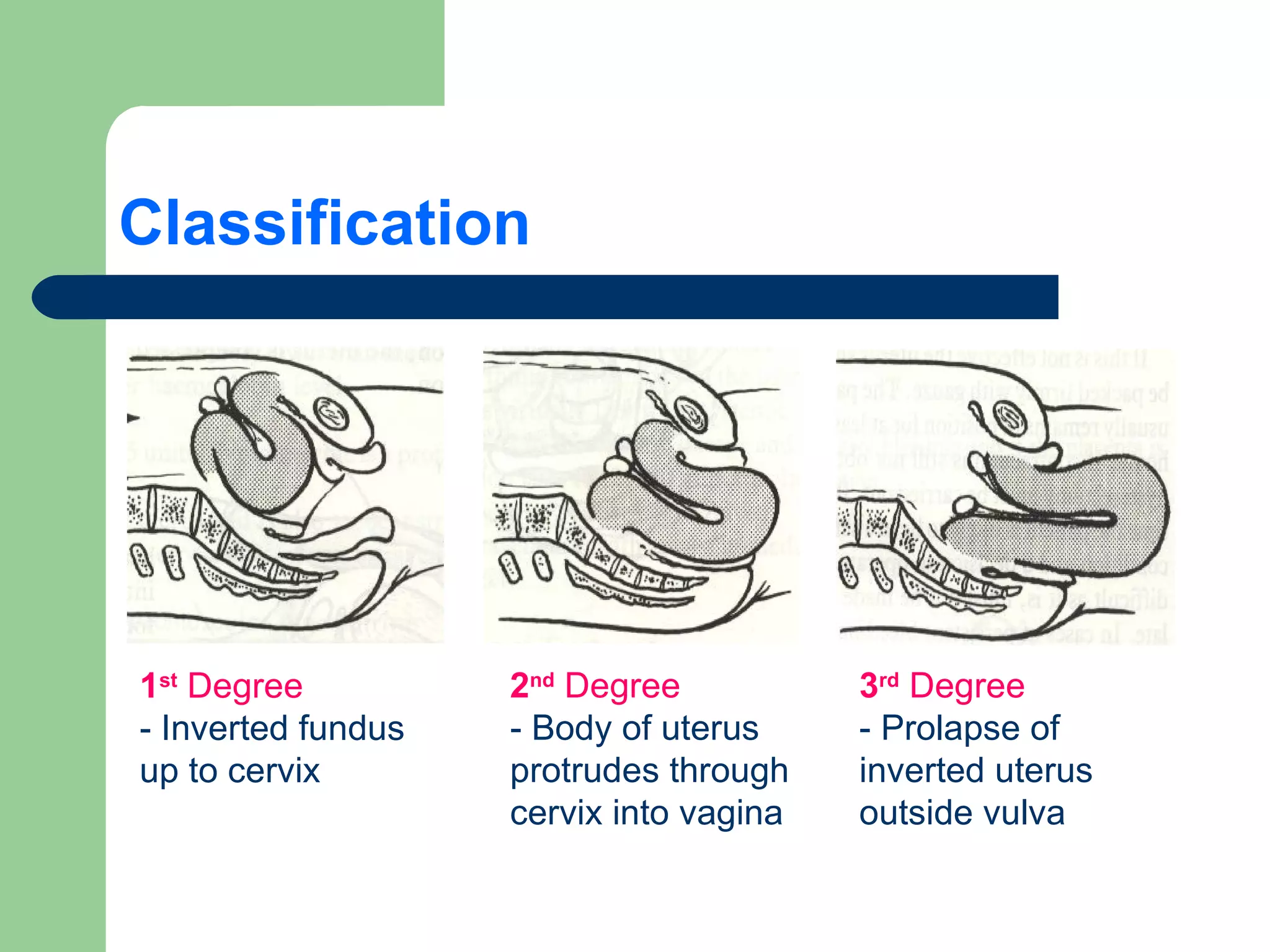 Uterine Inversion | PPT