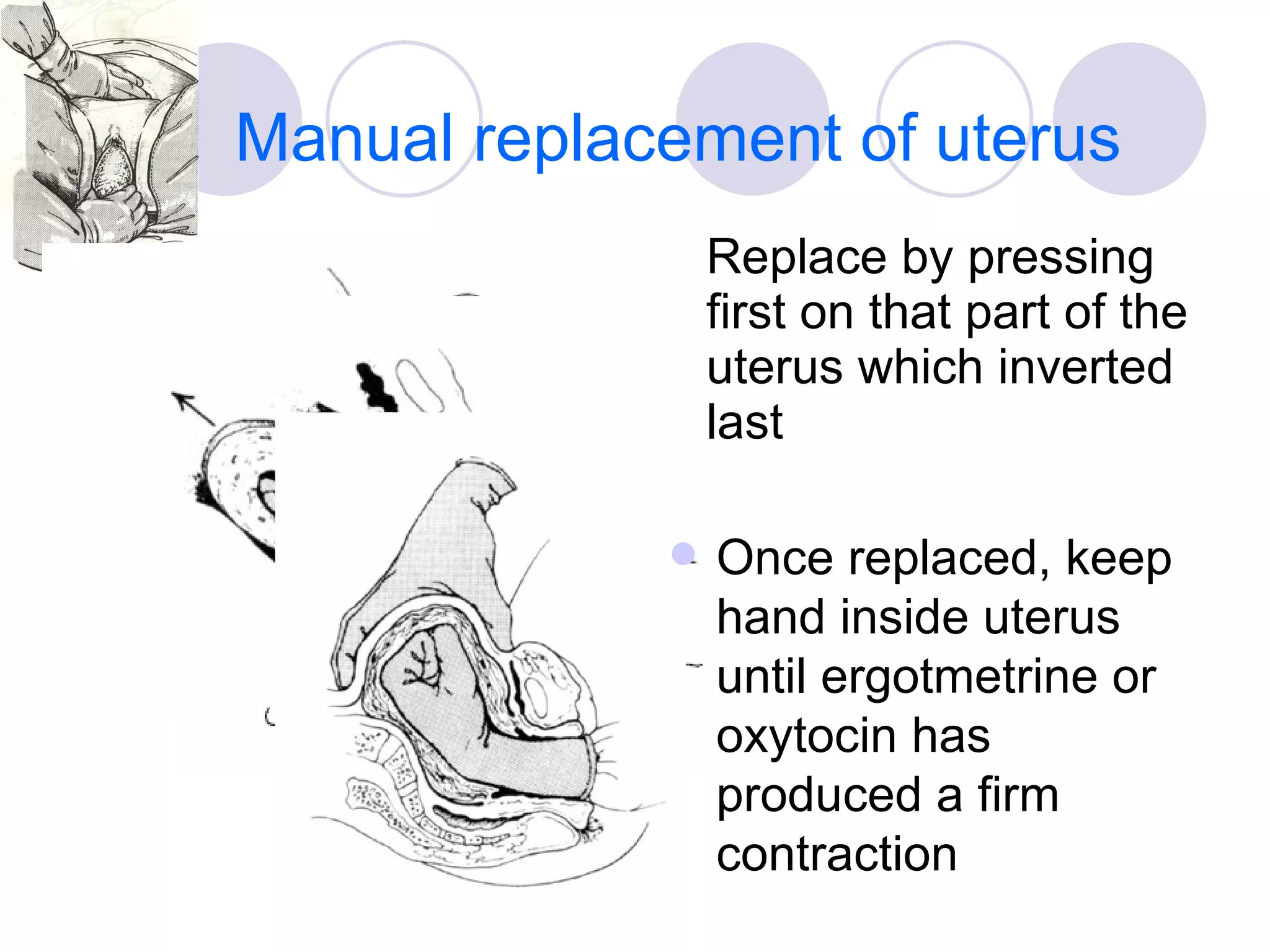 Uterine Inversion | PPT