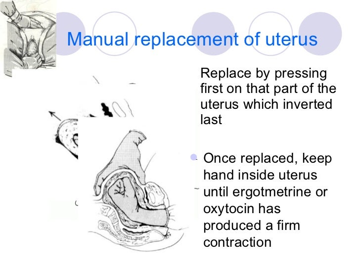Uterine Inversion
