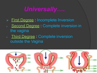 Uterine inversion | PPTX