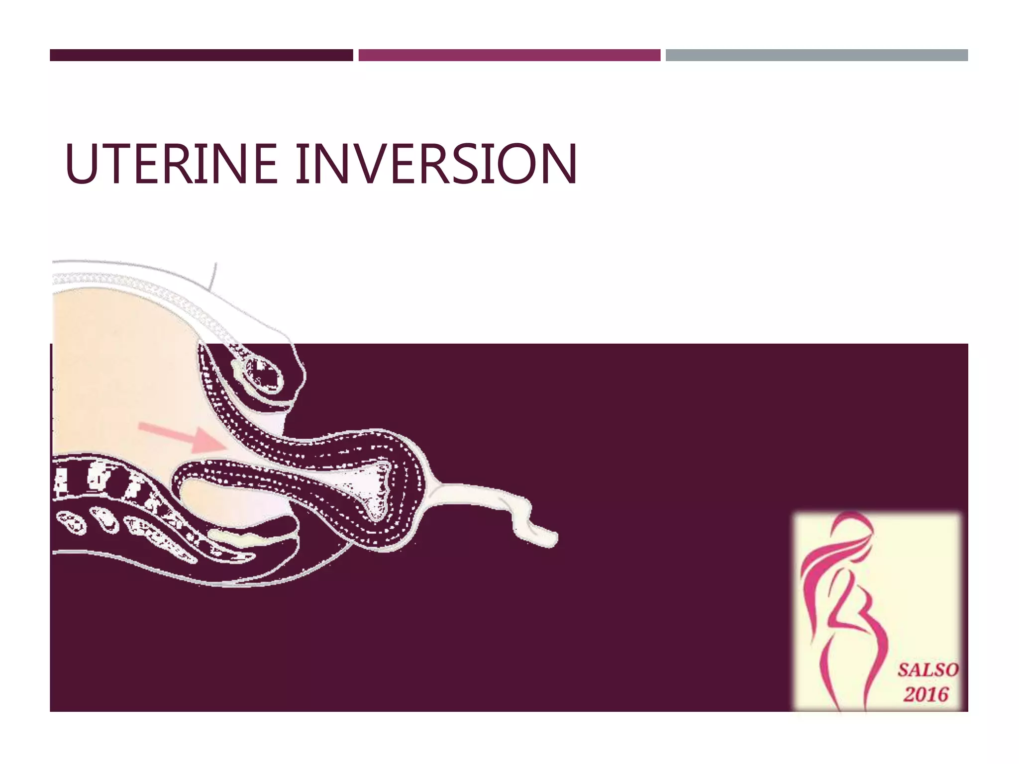 Uterine inversion 2016 | PPTX