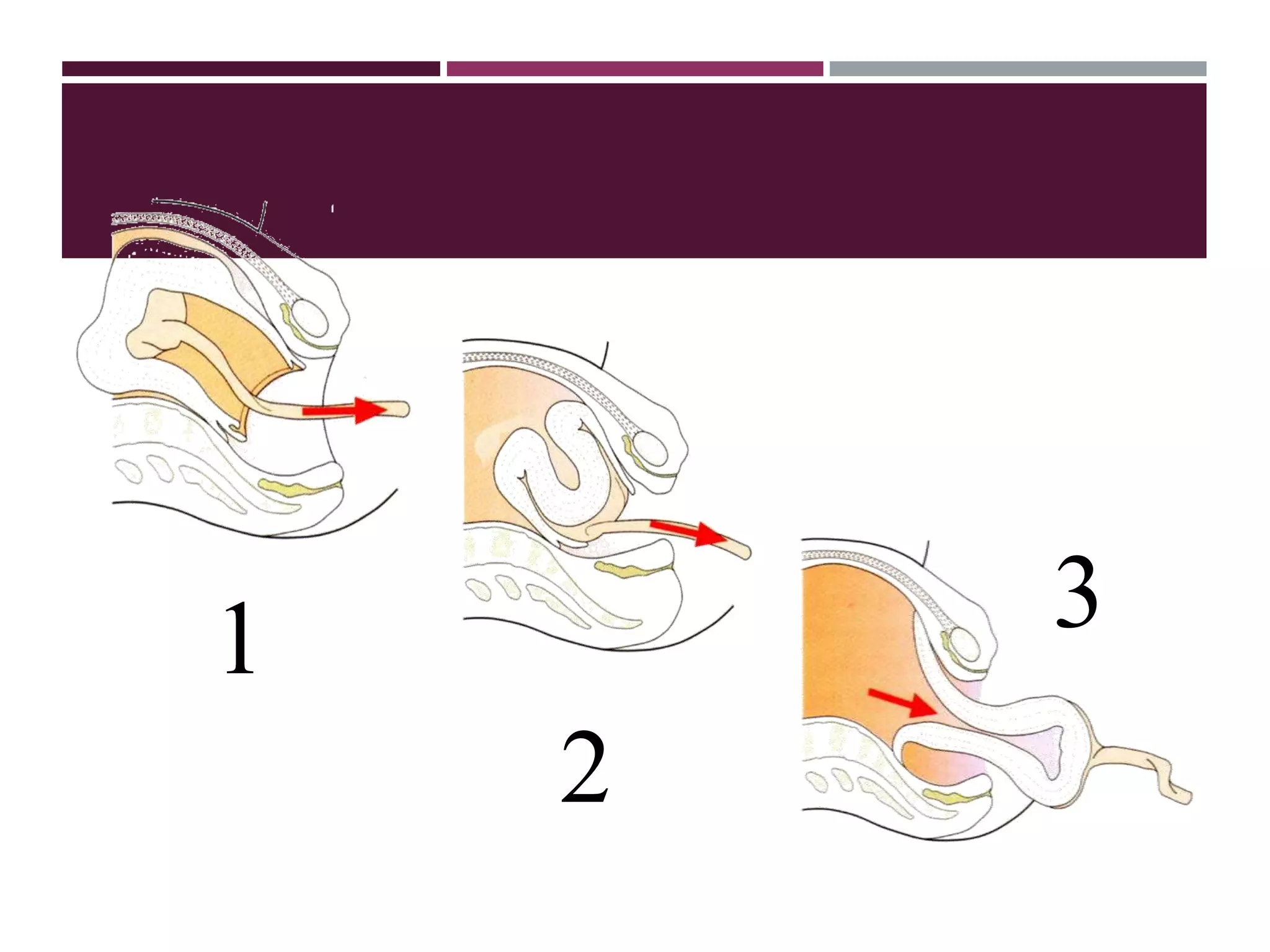Uterine inversion 2016 | PPTX