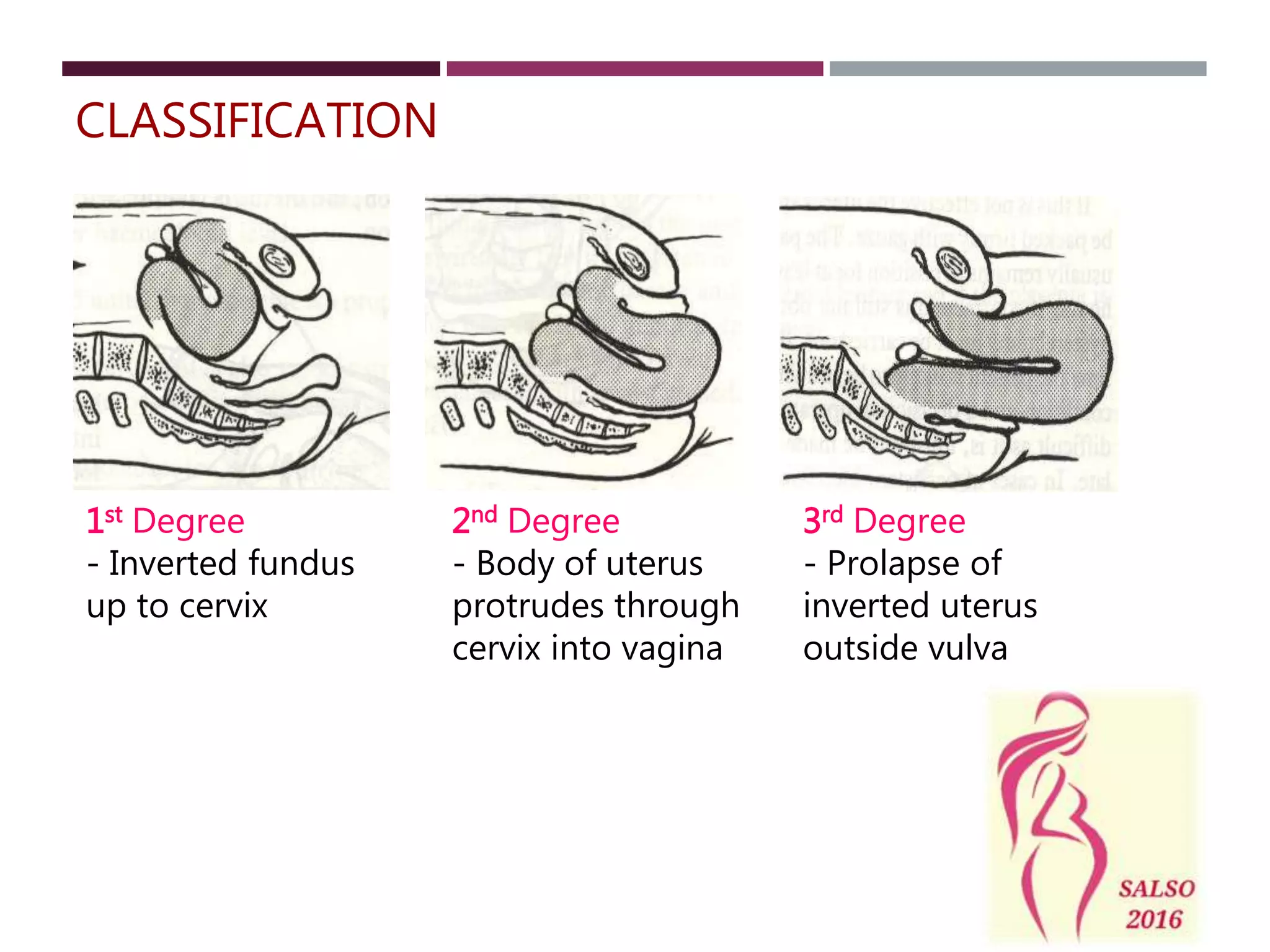 Uterine inversion 2016 | PPTX