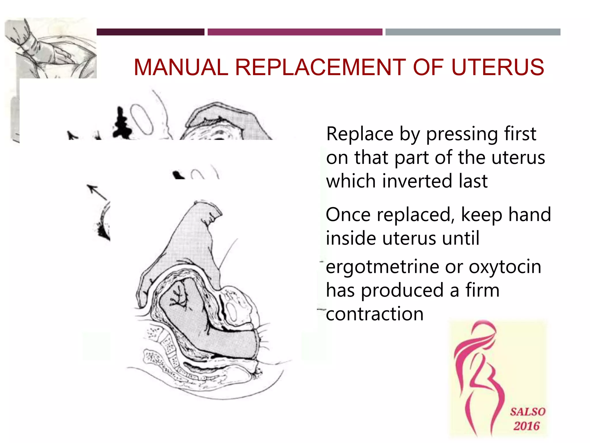 Uterine inversion 2016 | PPTX