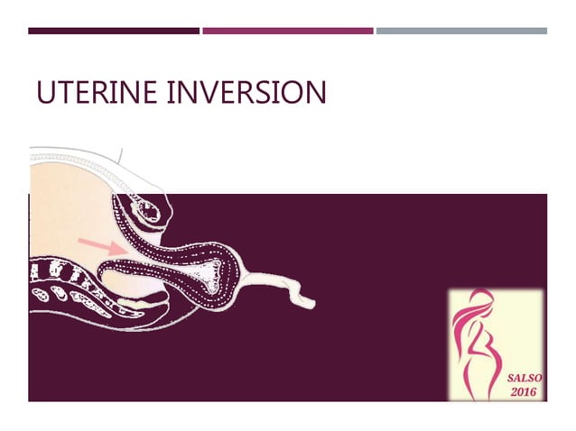 Uterine inversion 2016 | PPT
