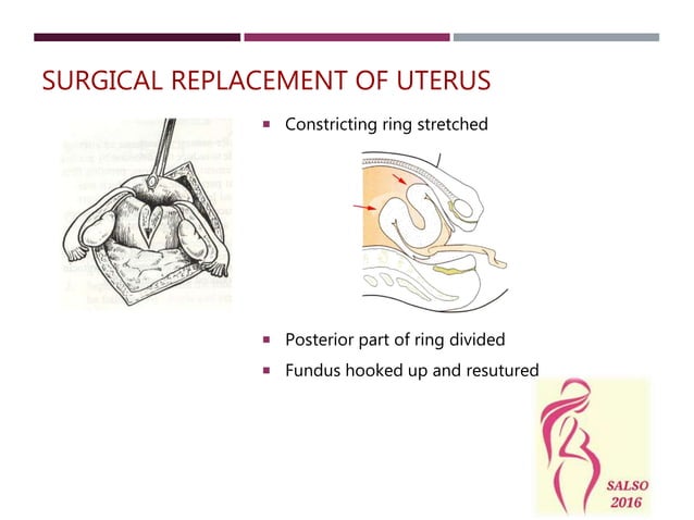 Uterine inversion 2016 | PPTX
