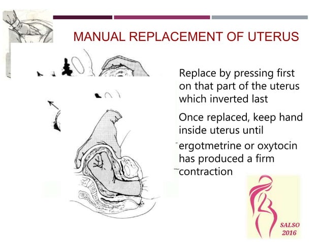 Uterine inversion 2016 | PPTX