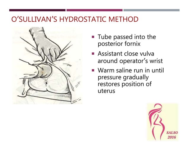 Uterine inversion 2016 | PPTX