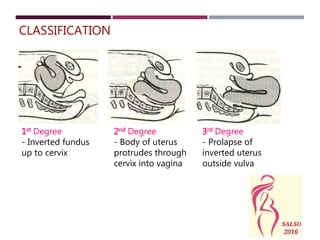 Inverted Uterus Diagram