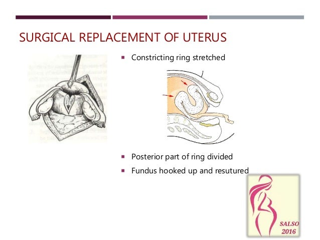 Uterine Inversion 2016