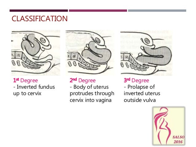 Inversao Uterina JADATM SYSTEM / SISTEMA GUIA RÁPIDO DE REFERÊNCIA