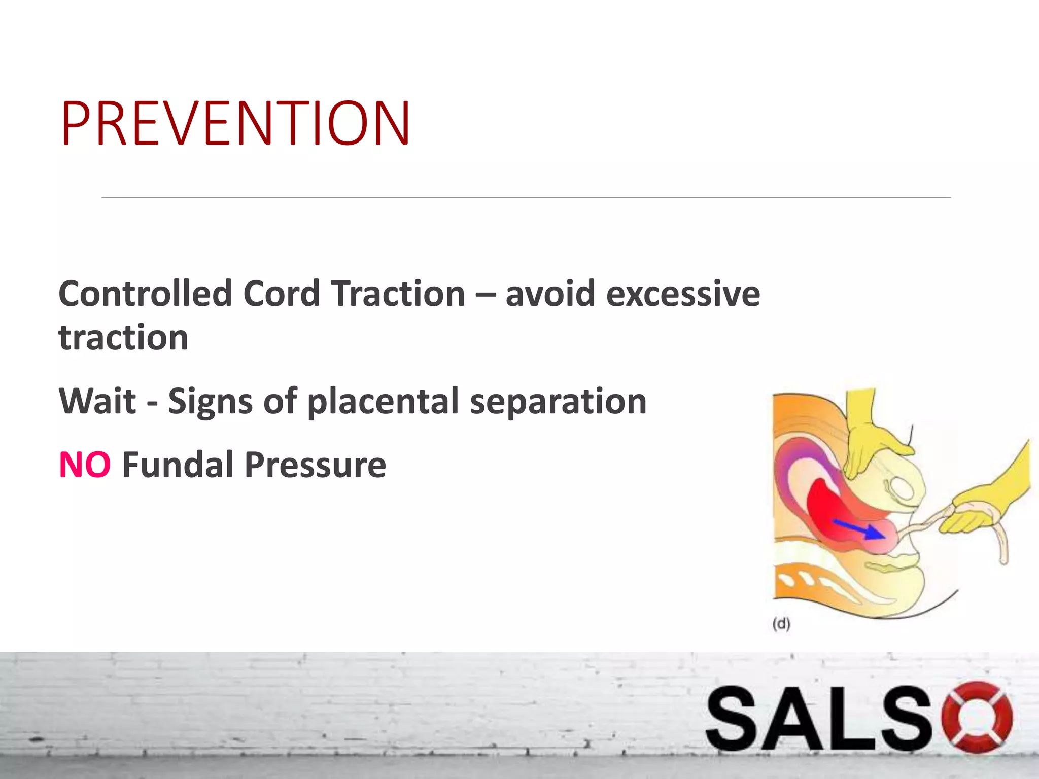 Uterine Inversion 2018 | PPTX