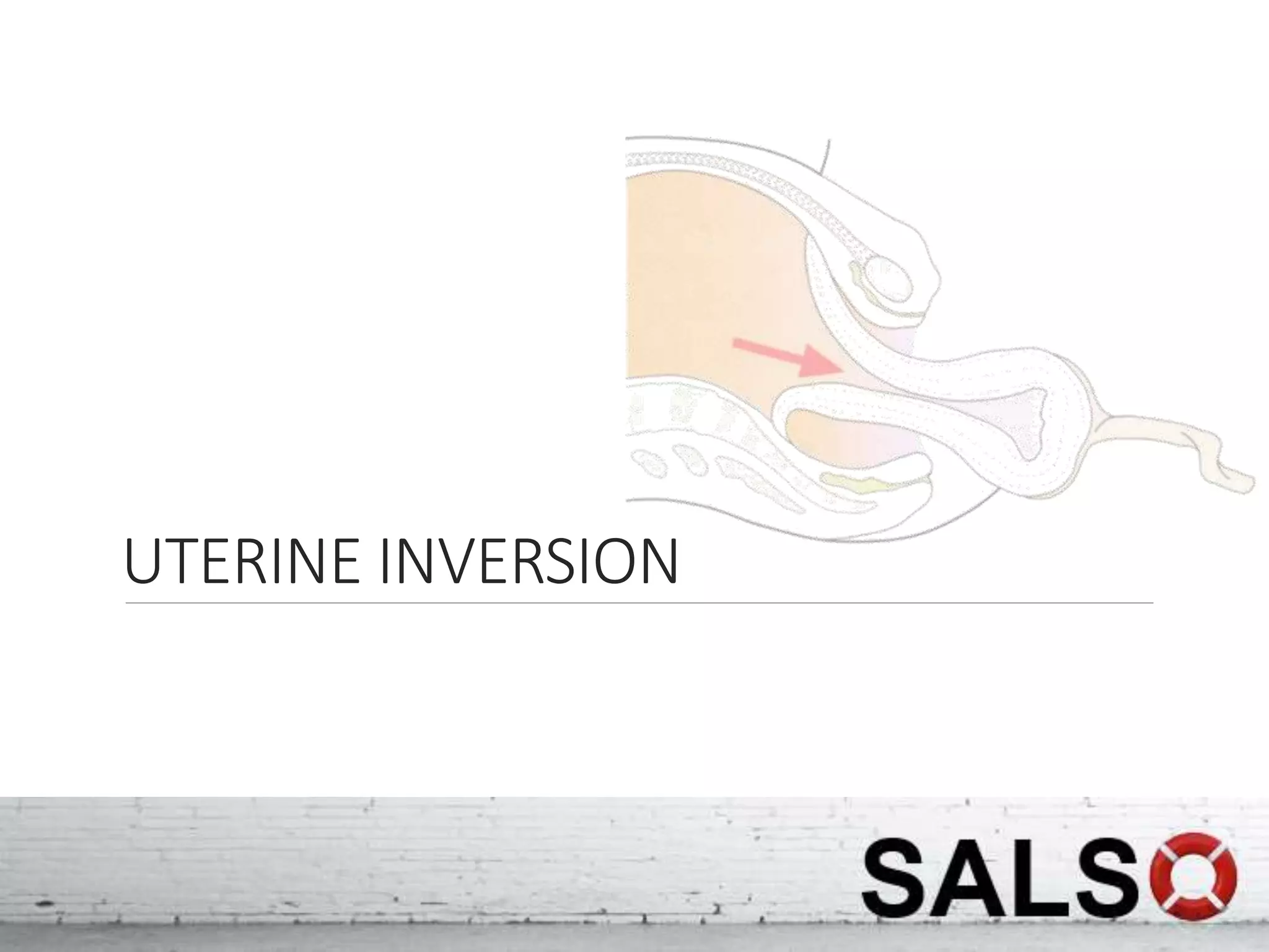 Uterine Inversion 2018 | PPTX