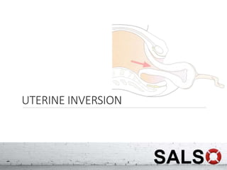 Uterine Inversion 2018 | PPTX