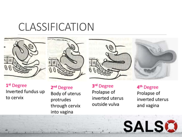 Uterine Inversion 2018 | PPT