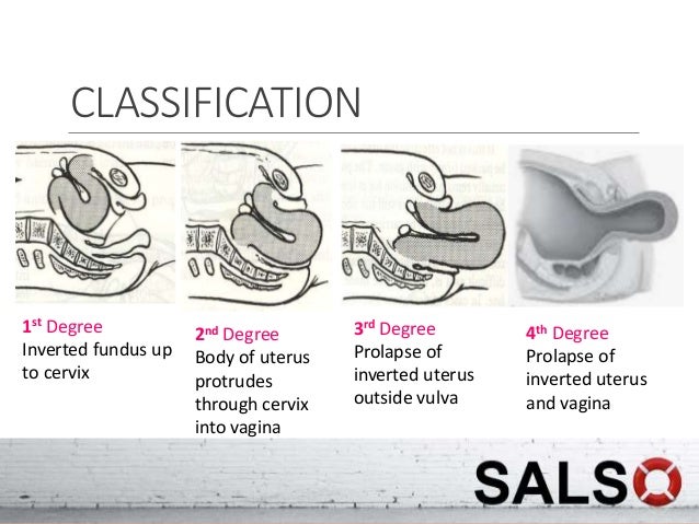Uterine Inversion 2018