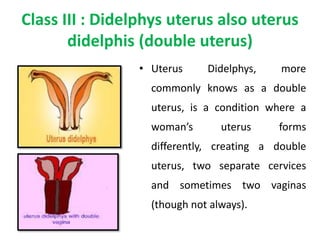 Uterine malformations | PPTX