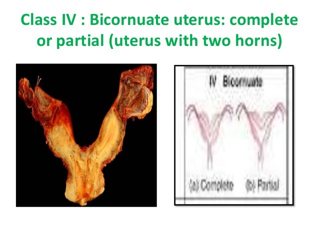 Uterine malformations