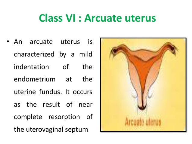 Uterine malformations