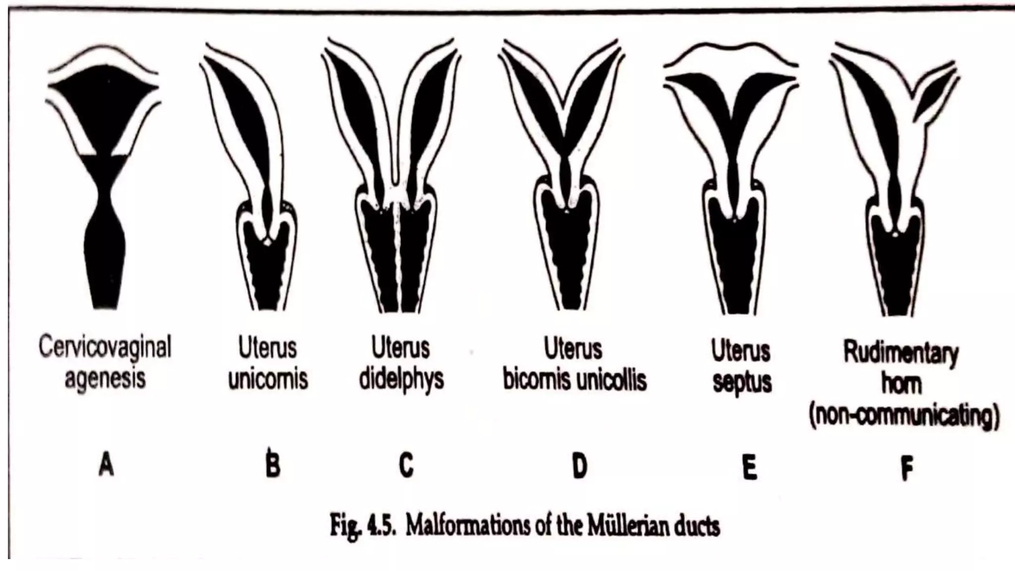 Uterine malformations | PPTX