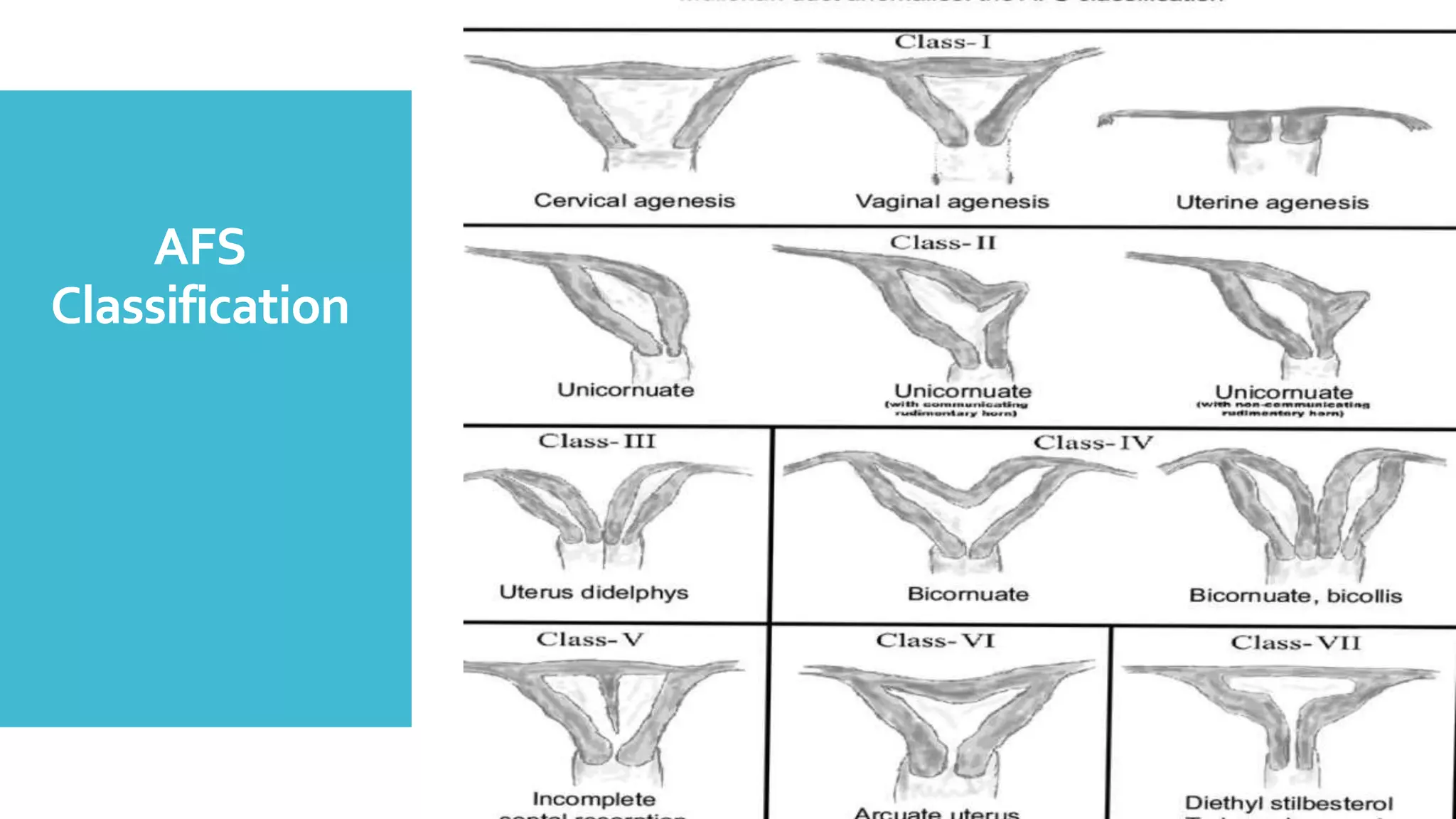 Uterine malformations | PPTX