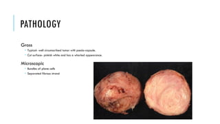 Uterine myoma........................ppt