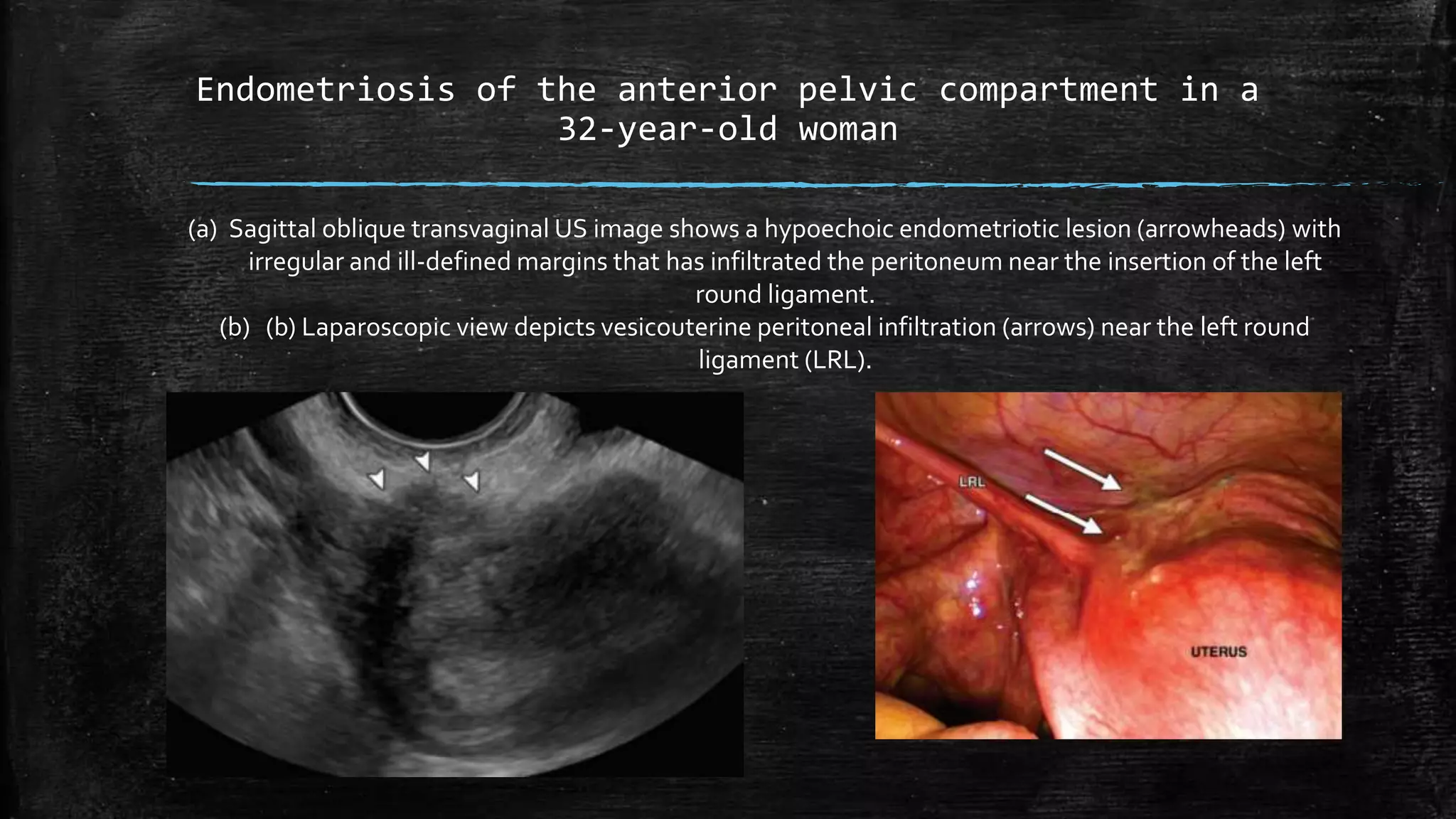 Uterine Myoma, Endometriosis, Endometrial Ca and.pptx